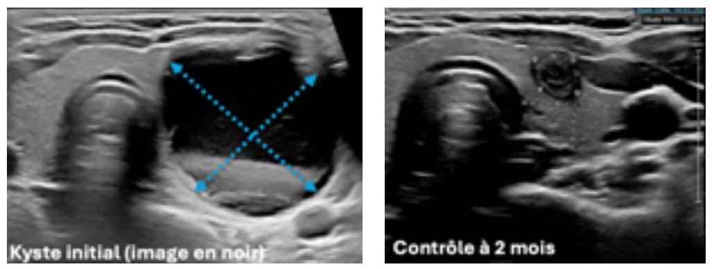 Traiter Un Nodule Thyroïdien Sans Chirurgie C Est Possible